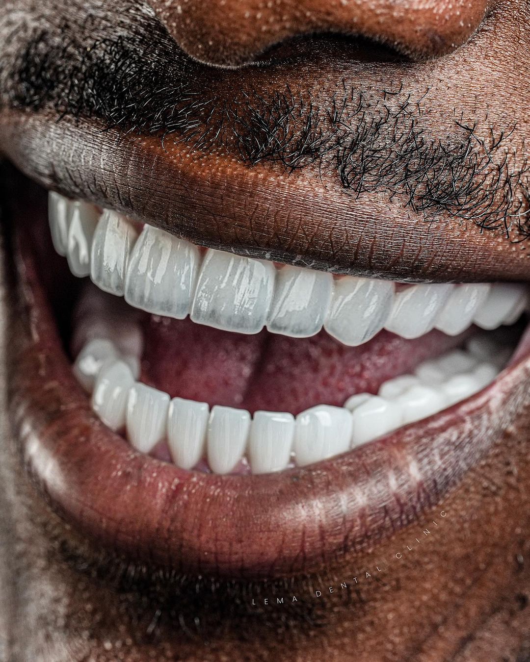 Dental Veneers Turkey - Lema Dental Clinic 2024