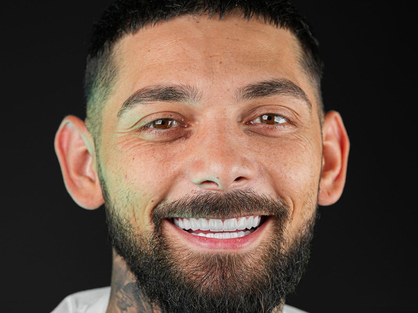 Hollywood Smile in Turkey 2024 - Lema Dental Clinic