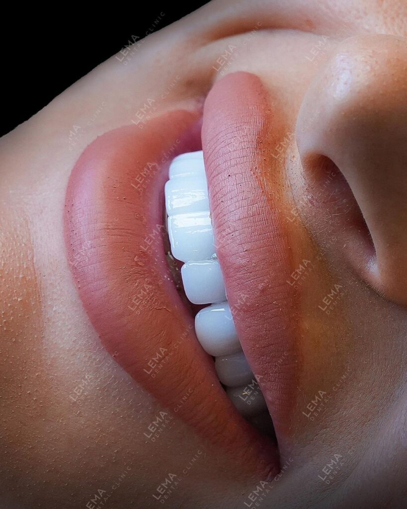 Crowns vs. Veneers Understanding the Difference Crowns vs. Veneers Understanding the Difference