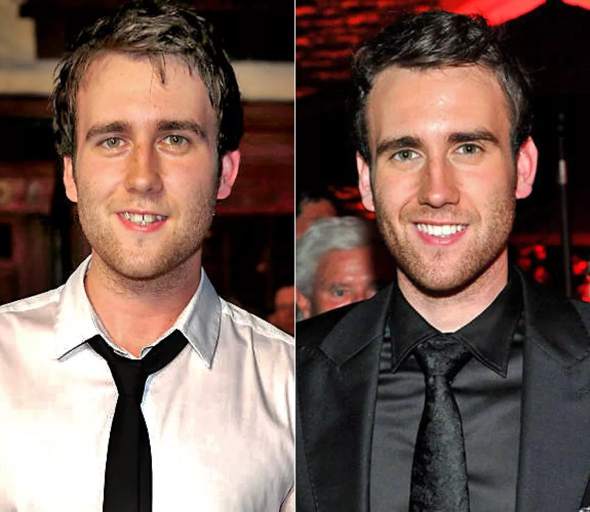 Matthew Lewis Teeth Makeover