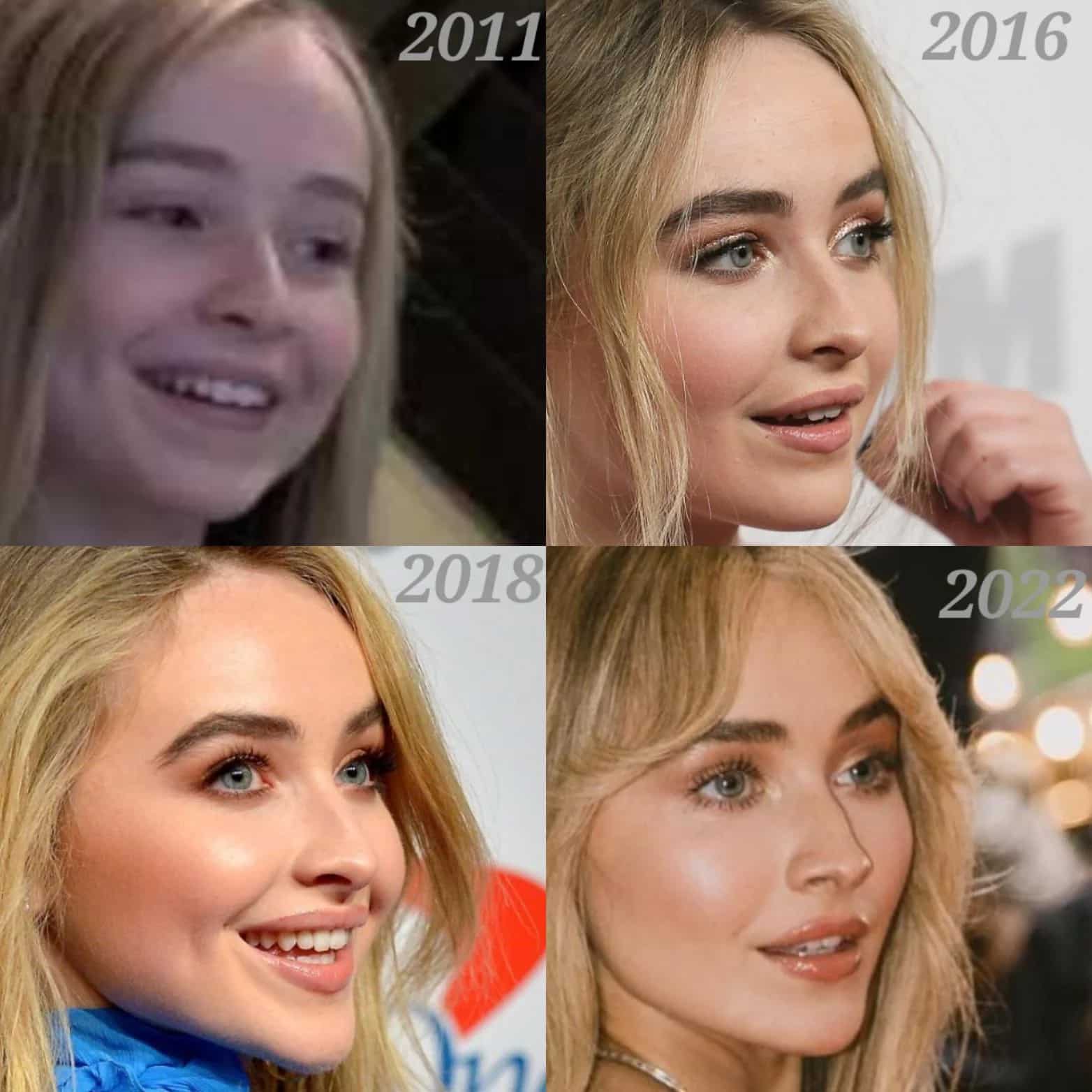 Sabrina Carpenter New Teeth: Before and After Veneers | LEMA