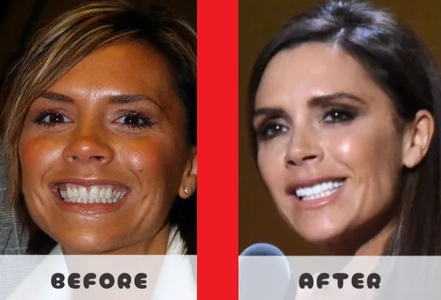 Zahnschmelzfluorose: Was Sie wissen müssen | Lema Dental Clinic