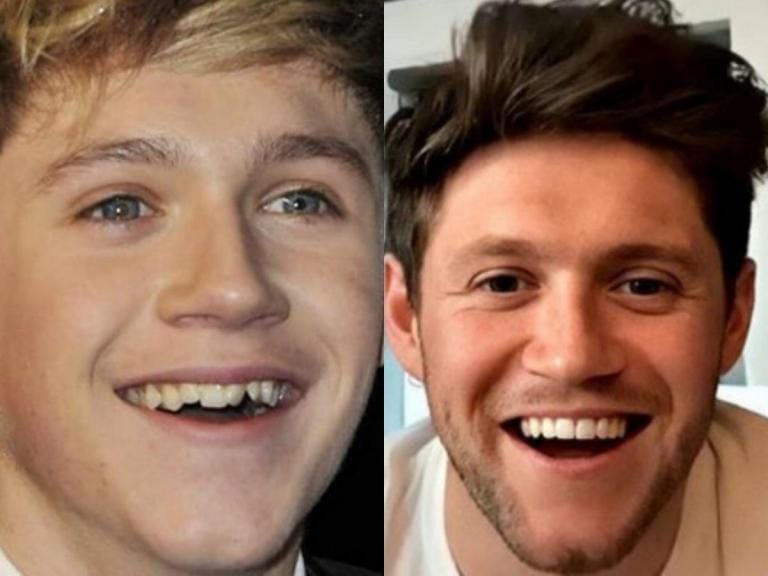 Brad Pitt Teeth (Old/New): Before and Afters! | LEMA