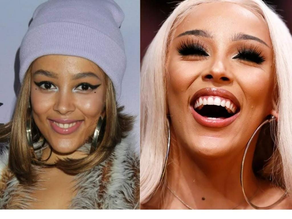 🦷 Los Dientes de Doja Cat Antes y Después - Lema Dental Clinic