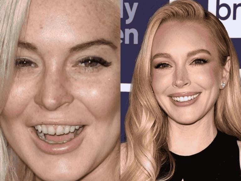 🦷 Lindsay Lohan New Teeth Now: Before/After in 2025 | LEMA