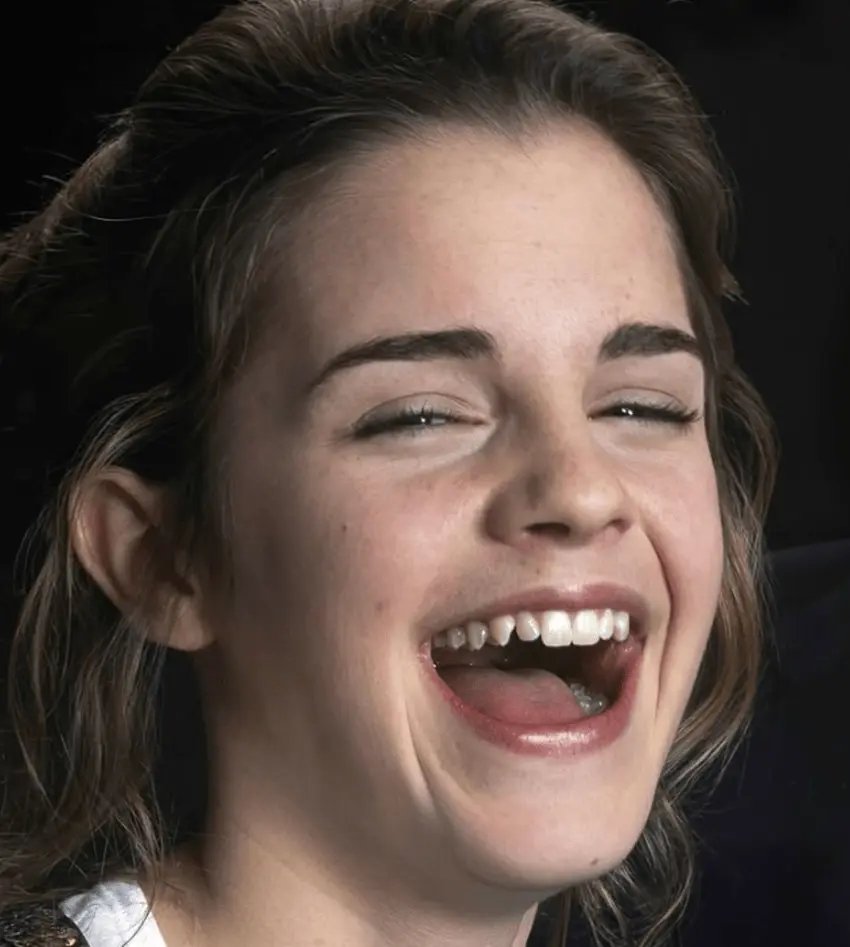 Emma Watson's New Teeth Transformation in Years | LEMA