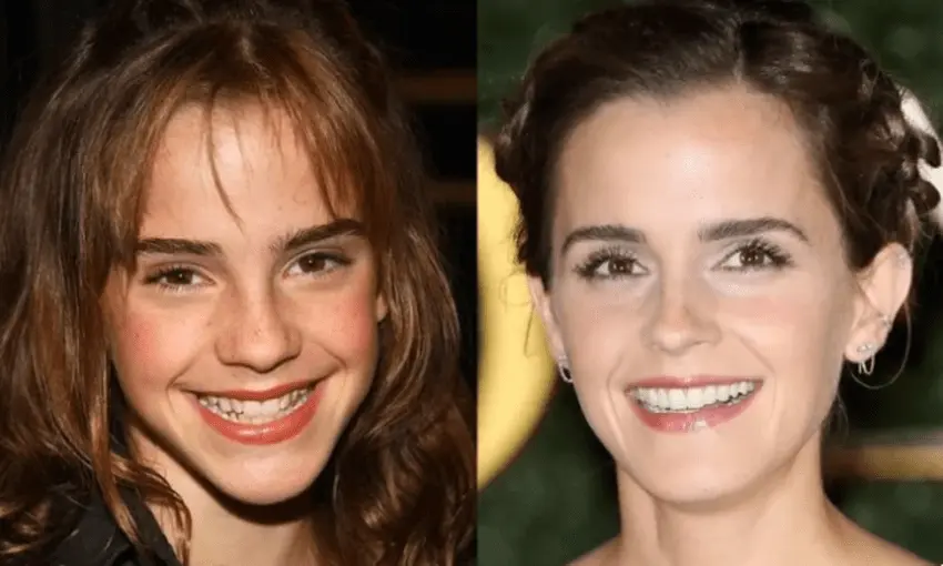 Emma Watson s New Teeth Transformation In Years LEMA