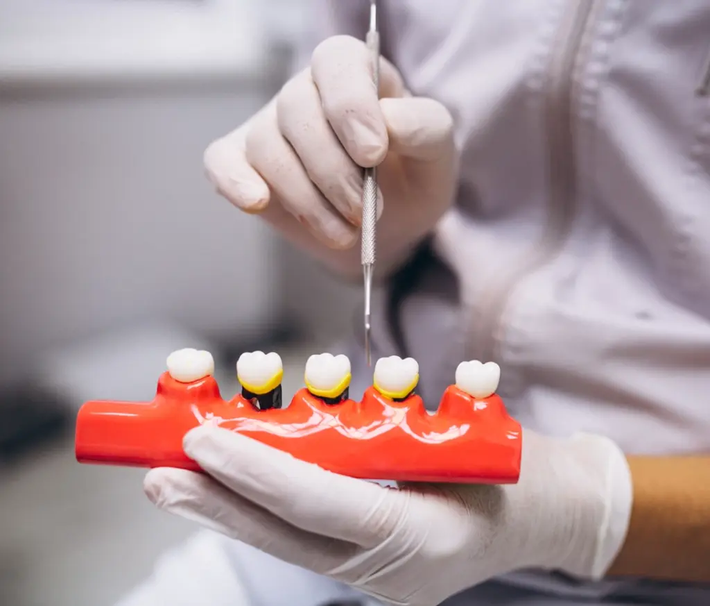 Types of Bridges for Teeth: Which One Is Right for You? | LEMA