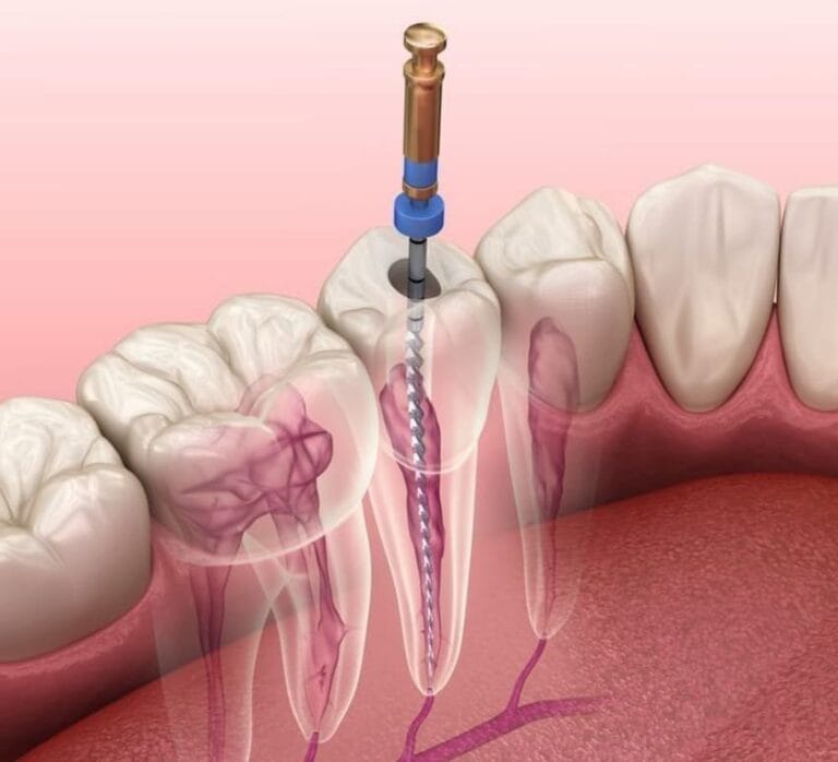 Dental Code D3346: Repeat Root Canal Treatment | LEMA