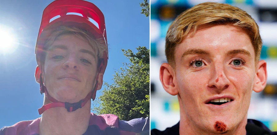 ⚽ Anthony Gordon Teeth Fixed Now? Before and Afters | LEMA