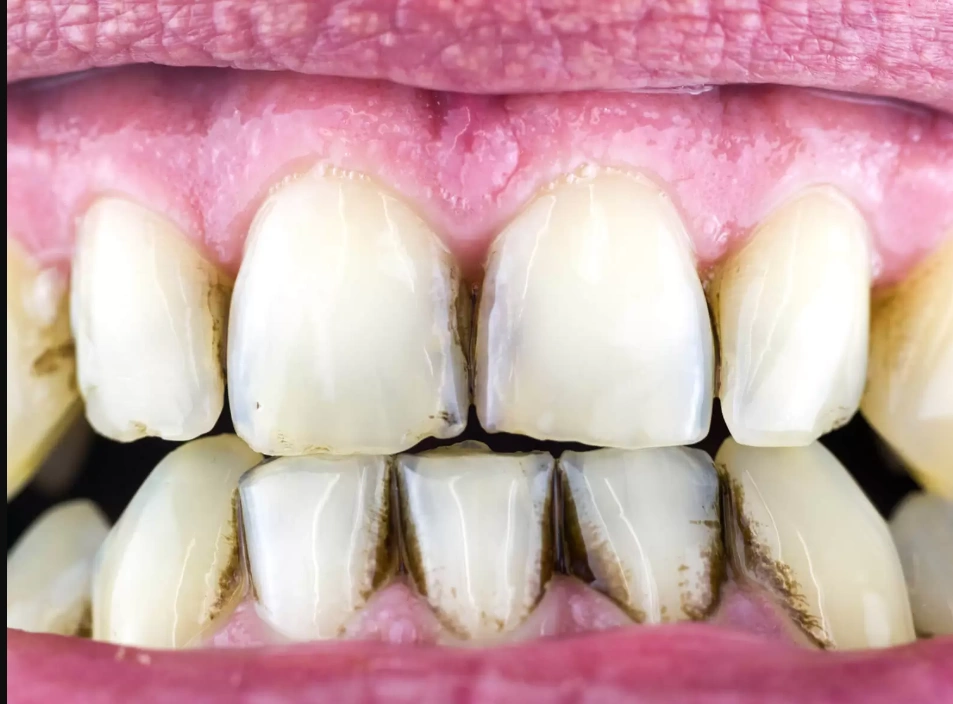 Tartre noir sur les dents : causes et options de traitement | Lema ...