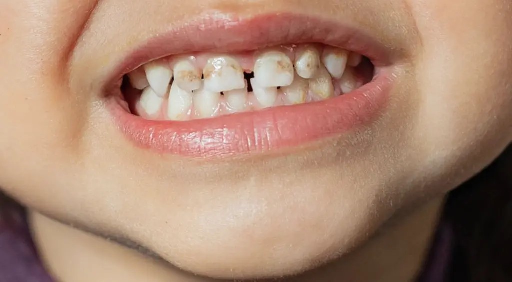 Enamel Hypoplasia: What It Is and How to Treat It | LEMA