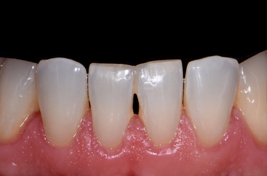 🦷 What are Dental Black Triangles? Causes and Treatments? | LEMA