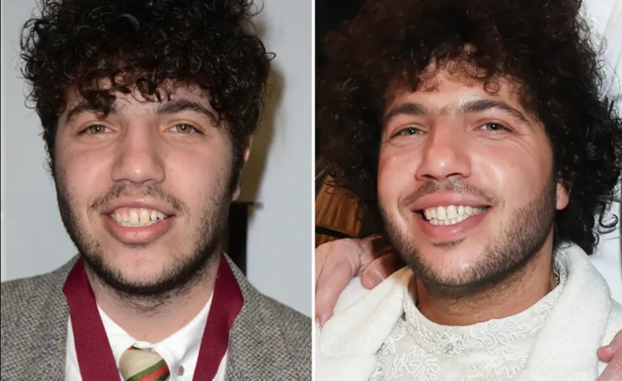 🦷Understanding And Treating Open Bite | LEMA