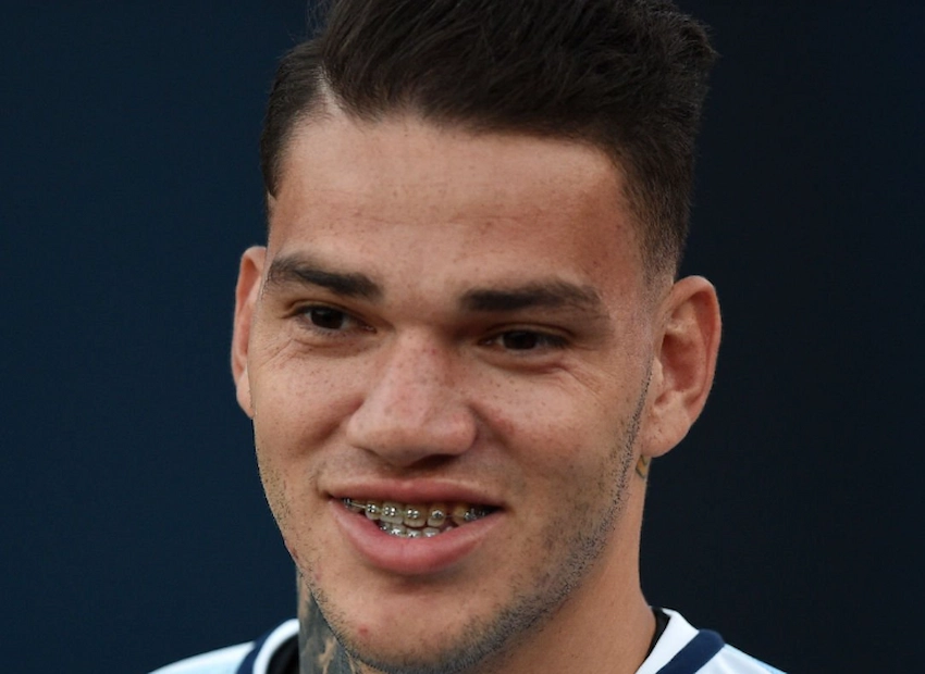 Trasformazione del sorriso di Ederson Moraes: Prima e Dopo | Lema ...