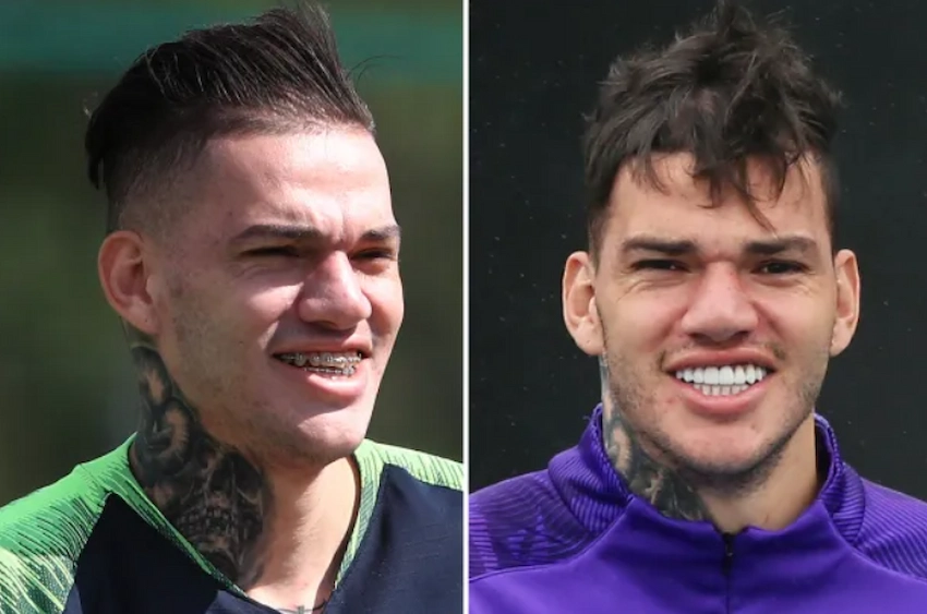 Ederson Moraes' Smile Transformation: Before and Afters | LEMA