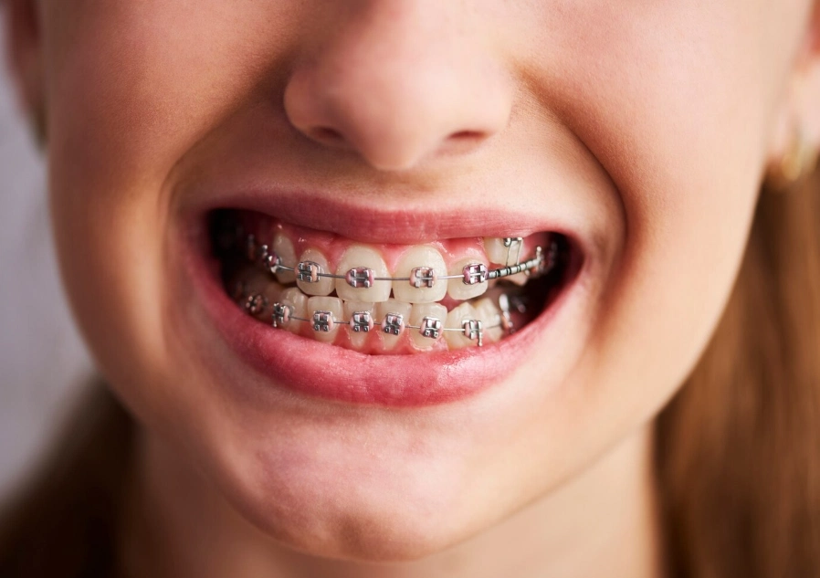 Common Smile Issues with Lower Teeth and How to Fix Them | LEMA
