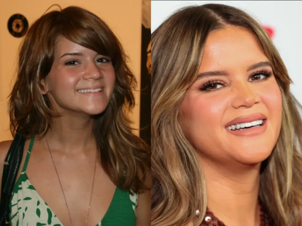 Η Μεταμόρφωση των Δοντιών της Maren Morris - Πριν και Μετά