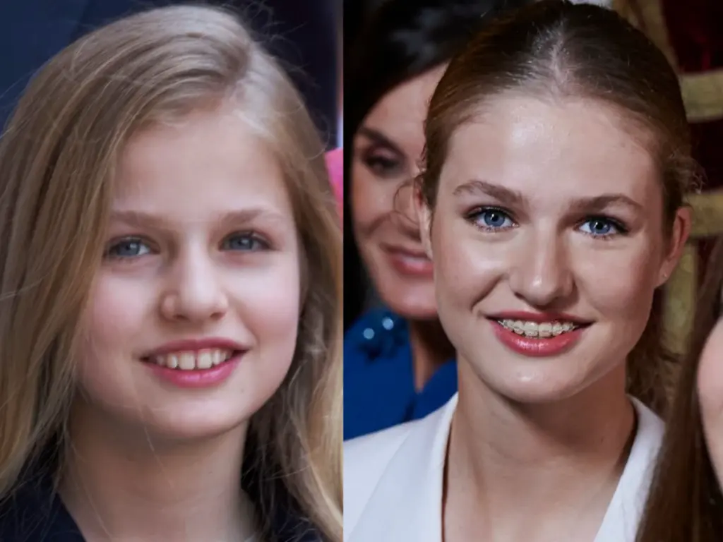 Prinsesse Leonors Tandsforvandling: Før og Efter
