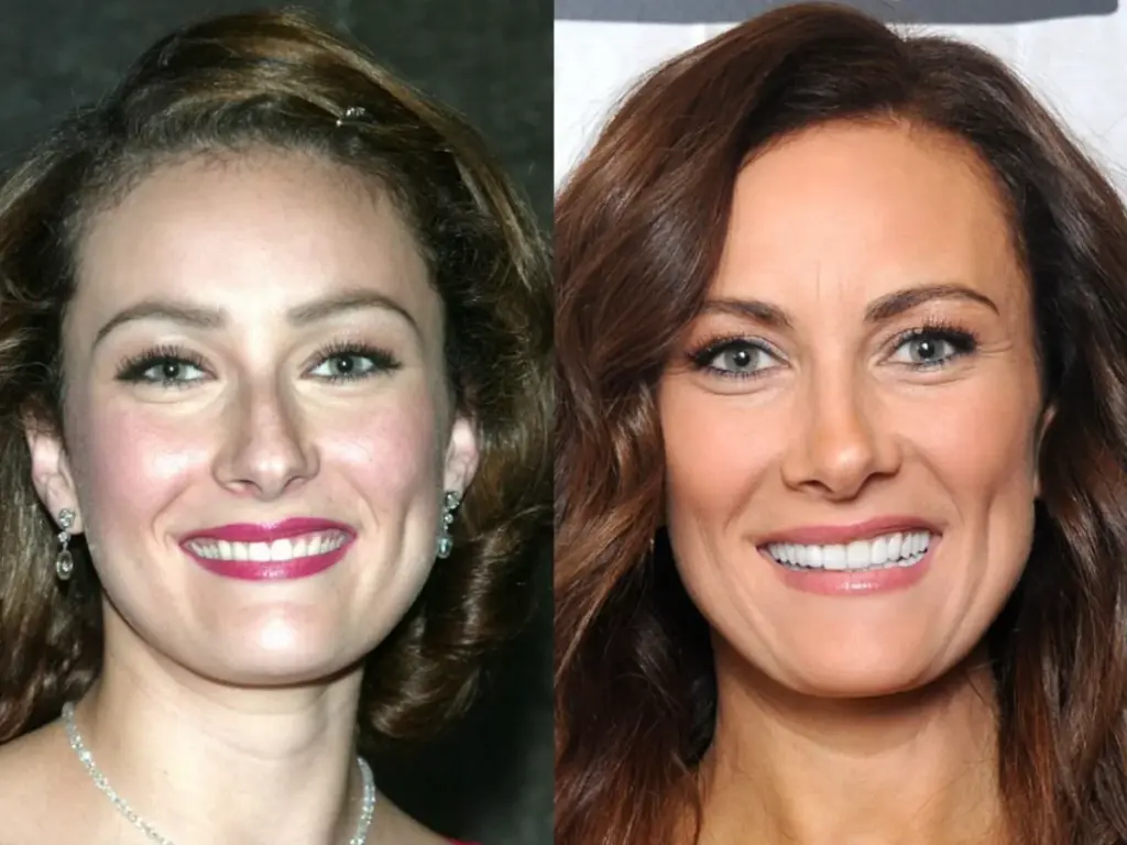 Laura Benanti's Teeth Transformation - Before and After | LEMA