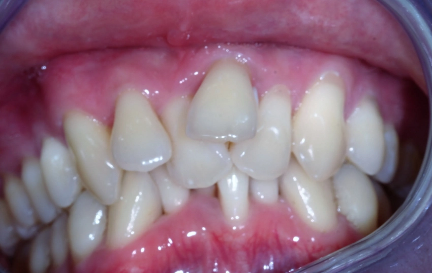 What Are Bicuspid Teeth and Why Are They Important? | LEMA