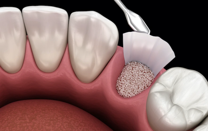 What is Bone Graft Dental Code D7953? | LEMA