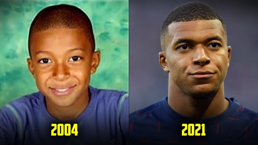 Dientes de Kylian Mbappé (Antiguos/Nuevos): Antes y Después | Lema ...