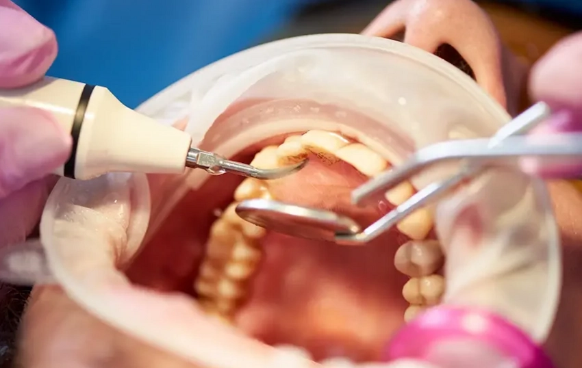 What Are Bicuspid Teeth and Why Are They Important? | LEMA