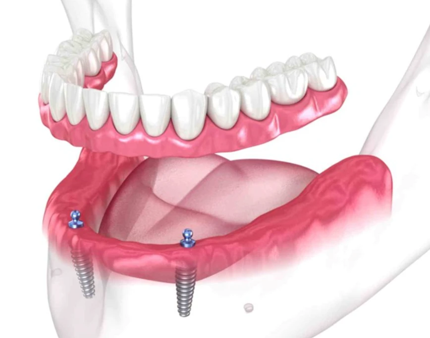 Alveolar Ridge Loss: Causes, Effects, and How to Prevent It | LEMA