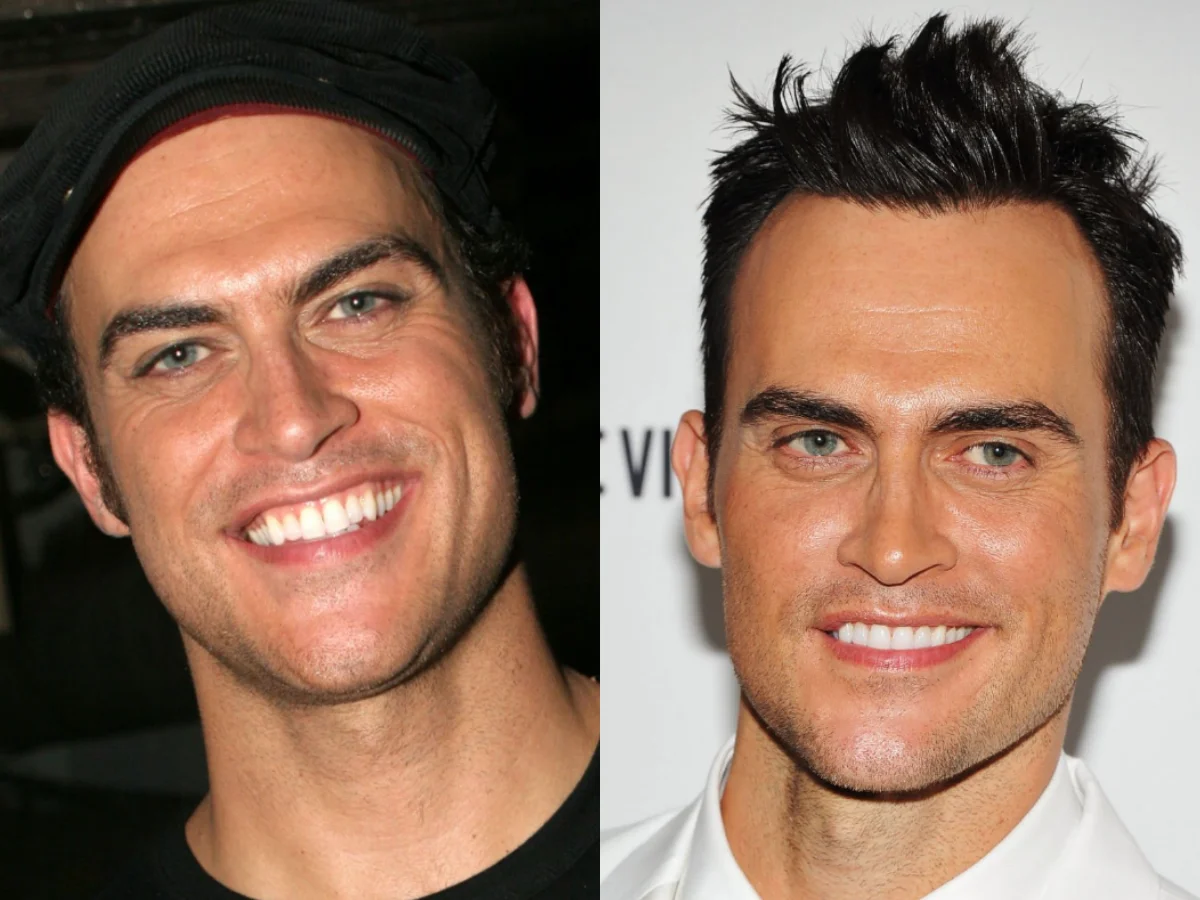 Cheyenne Jackson's Smile Transformation - Before and After | LEMA
