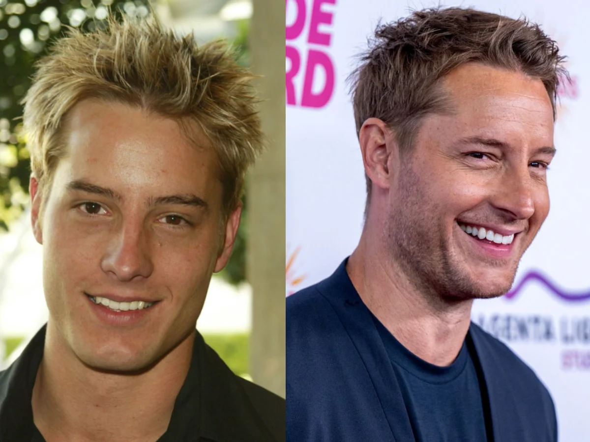 Justin Hartley’s Teeth Transformation: Before and After | LEMA