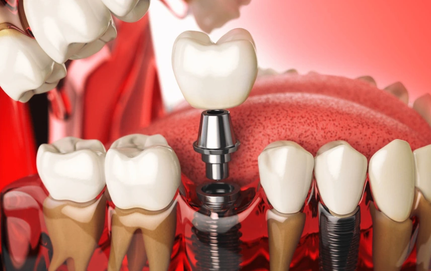 How Do You Clean Full Mouth Dental Implants? | LEMA
