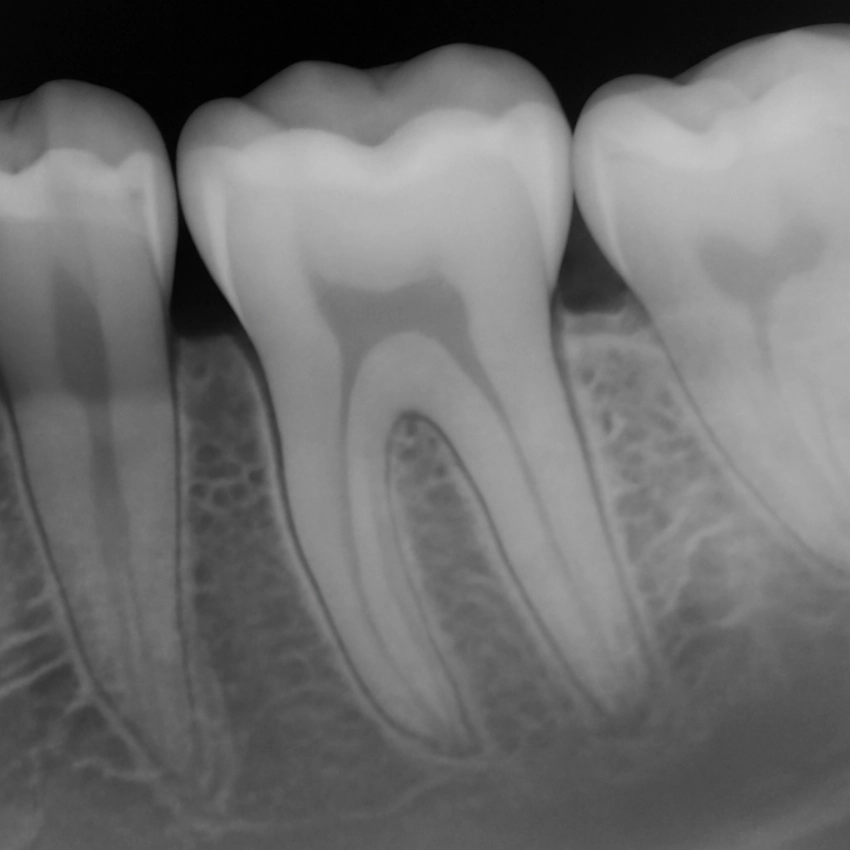 Dental Code D0707: Intraoral – Periapical Radiographic Image | LEMA