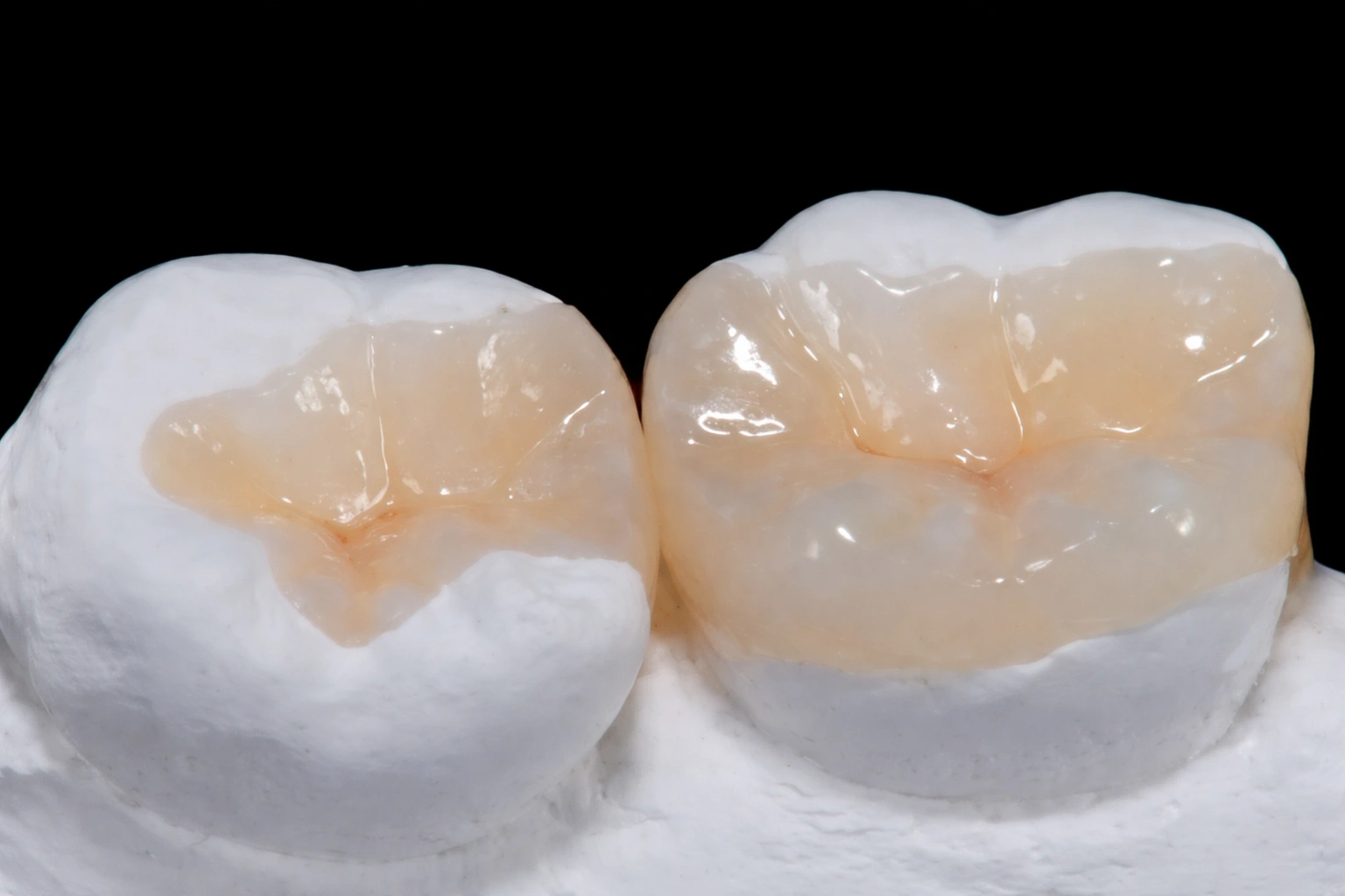 Inlay vs Onlay vs Filling: Which is the Best Dental Solution for You ...