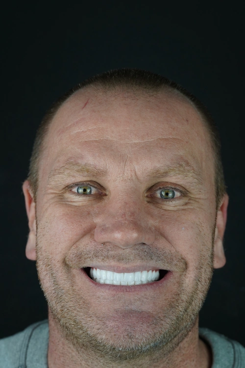 Kaip atrodo All-on-4 implantai