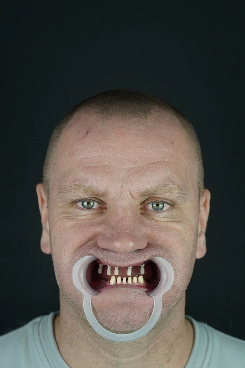 All-on-8 Zirkono implantai Turkijoje Kodėl tai geriausias pasirinkimas