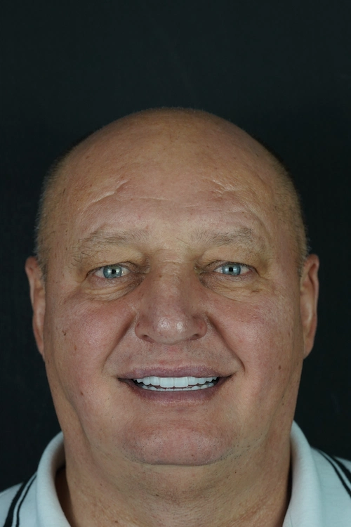 Do All-on-4 Dental Implants in Turkey Feel Natural? | LEMA