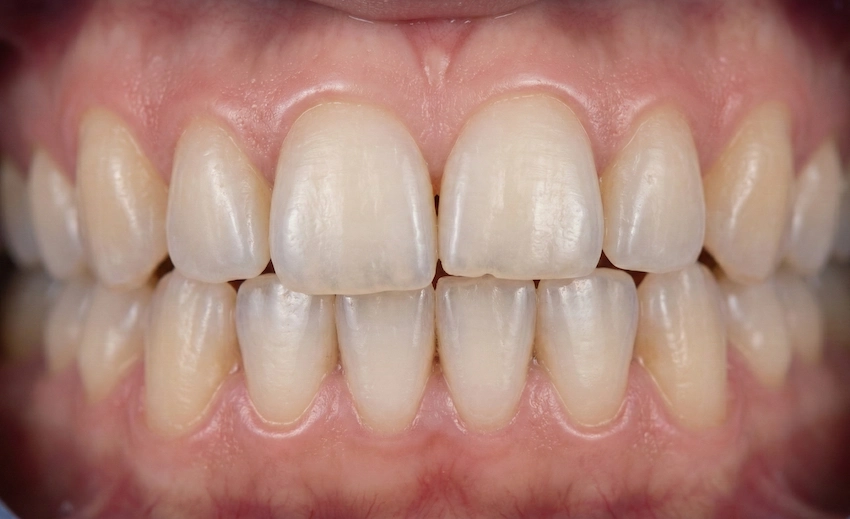 How Do You Fix Misaligned Midline Teeth? | LEMA