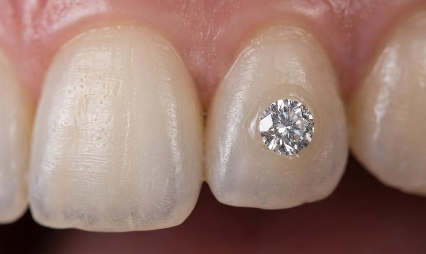 Do Teeth Need to Be Drilled for Dental Diamonds? | LEMA