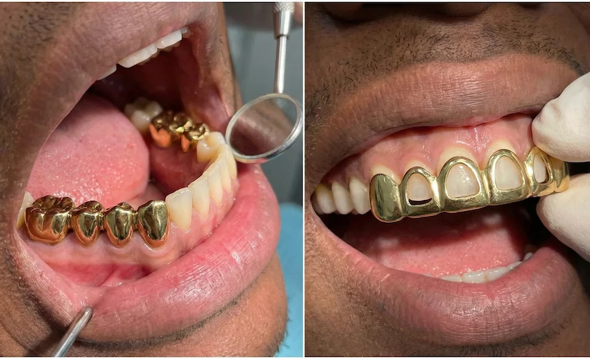 Permanent Gold Teeth and Grillz: Which Is Riskier? | LEMA