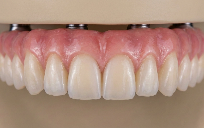 What Are Fixed Full Arch Dental Implants? | LEMA