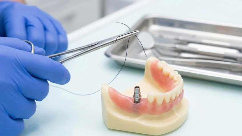 Do You Have Stitches With a Tooth Implant? | LEMA