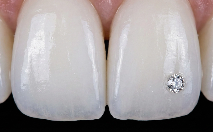 Why Teeth Whitening Should Be Done Before Dental Jewelry? | LEMA