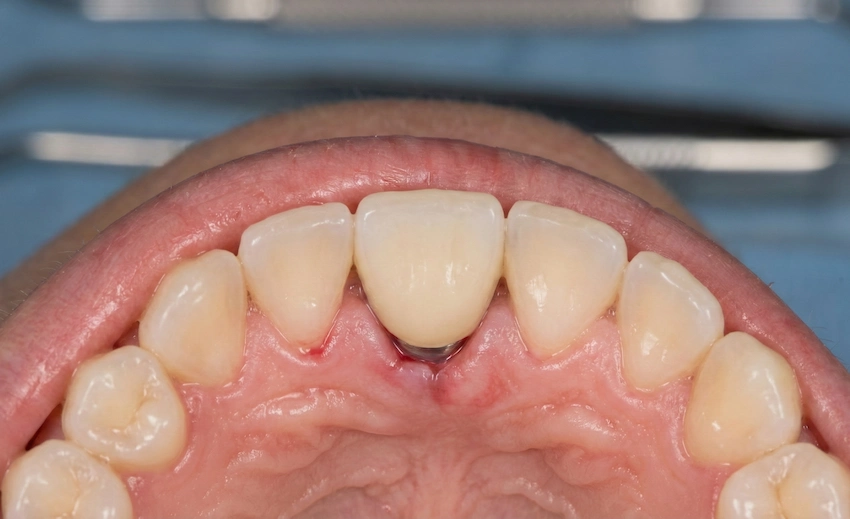 How to Recognize Failed Dental Implants? | LEMA