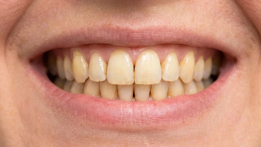 Can You Reverse Tooth Discoloration? | LEMA