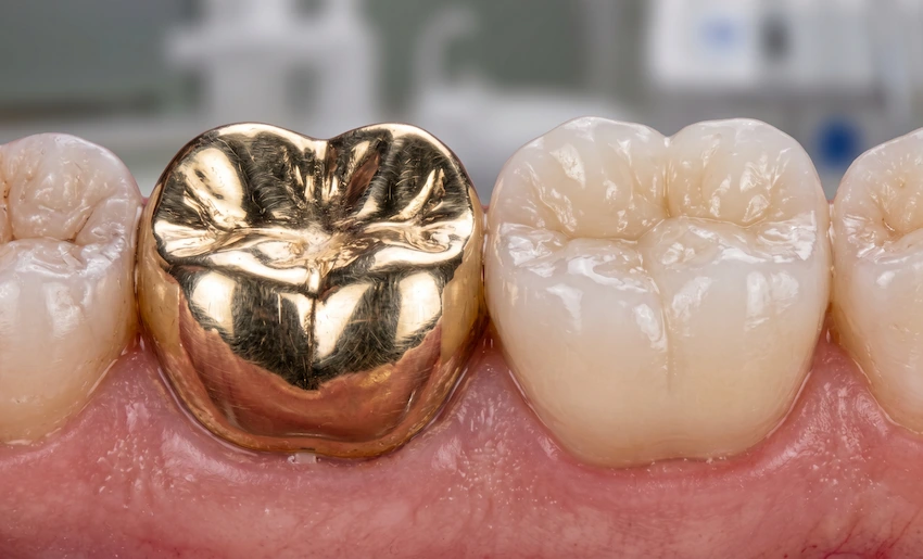 Gold Crowns vs. Zirconia: Which Is the Better Investment? | LEMA