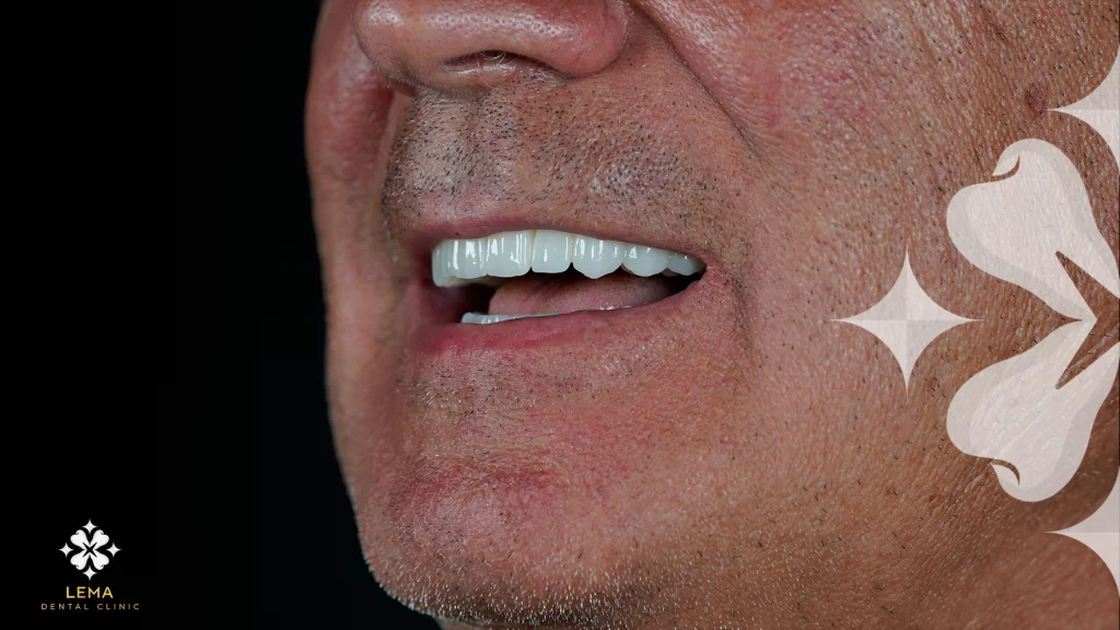 5 Ways To Get Rid Of Coffee Stain on Teeth 2025
