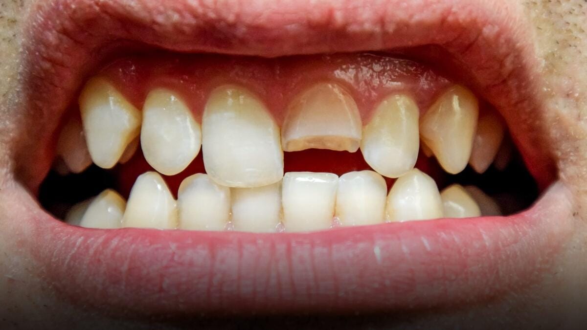 Understanding Cracked Tooth: Causes, Symptoms, and Solutions