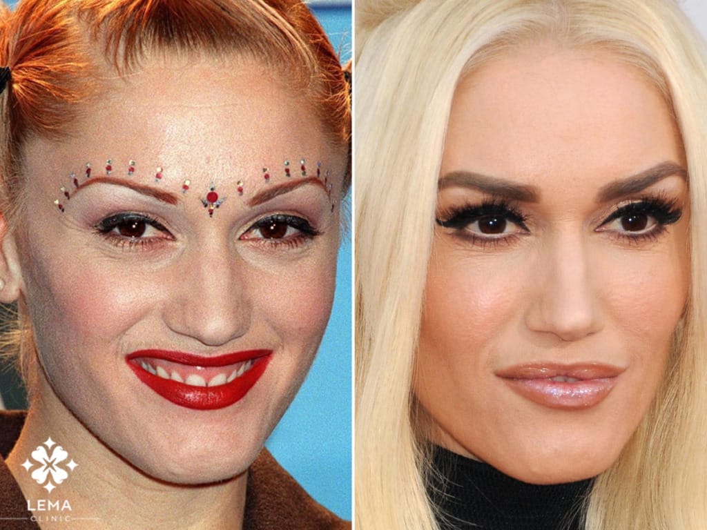 De Ce Se Efectuează Chirurgia Gummy Smile Lema Dental Clinic