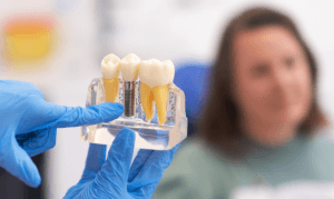 D6245 Dental Code: Ceramic Pontic on Implants Explained | LEMA
